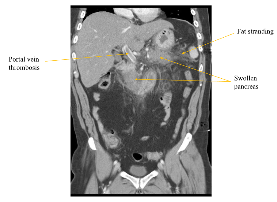 Acute Pancreatitis – MLA Medics