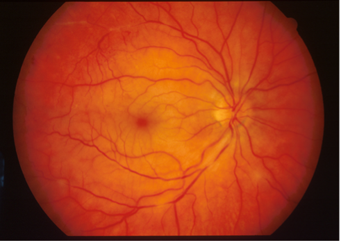 Acute Change in or Loss of Vision Station – Mind The Bleep